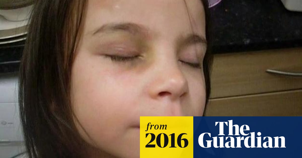 Ellie Butler Appears In Home Video With Dark Mark Around Her Eye During