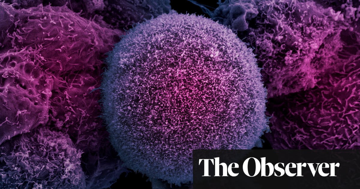 Prostate Cancer Breakthrough As UK Team Develops More Accurate Test prostate-cancer-breakthrough-as-uk-team-develops-more-accurate-test
