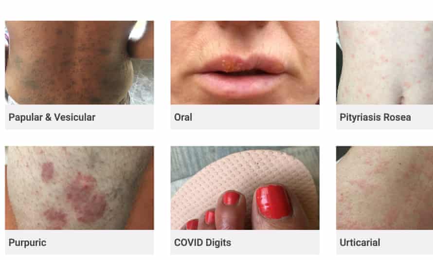 Covid 19 Skin Rash Website Criticised For Lack Of BAME Examples covid-19-skin-rash-website-criticised-for-lack-of-bame-examples
